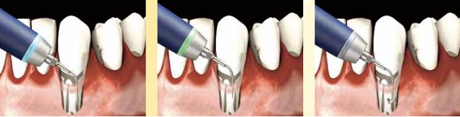 Купить Скалер ультразвуковой PerioScan, автономный, в комплекте с ...